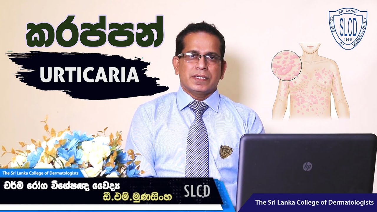 Urticaria - කරප්පන් - Dr. D. M. Munasinghe (Consultant Dermatologist) #skincare #dermatology ...