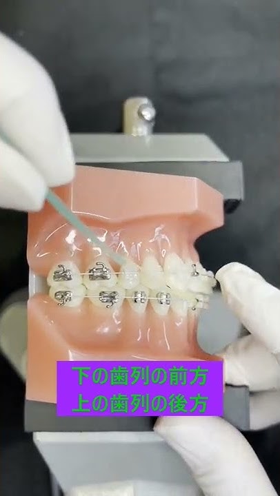 【矯正器具解説】顎間ゴム| intermaxillary elastics|#shorts - YouTube