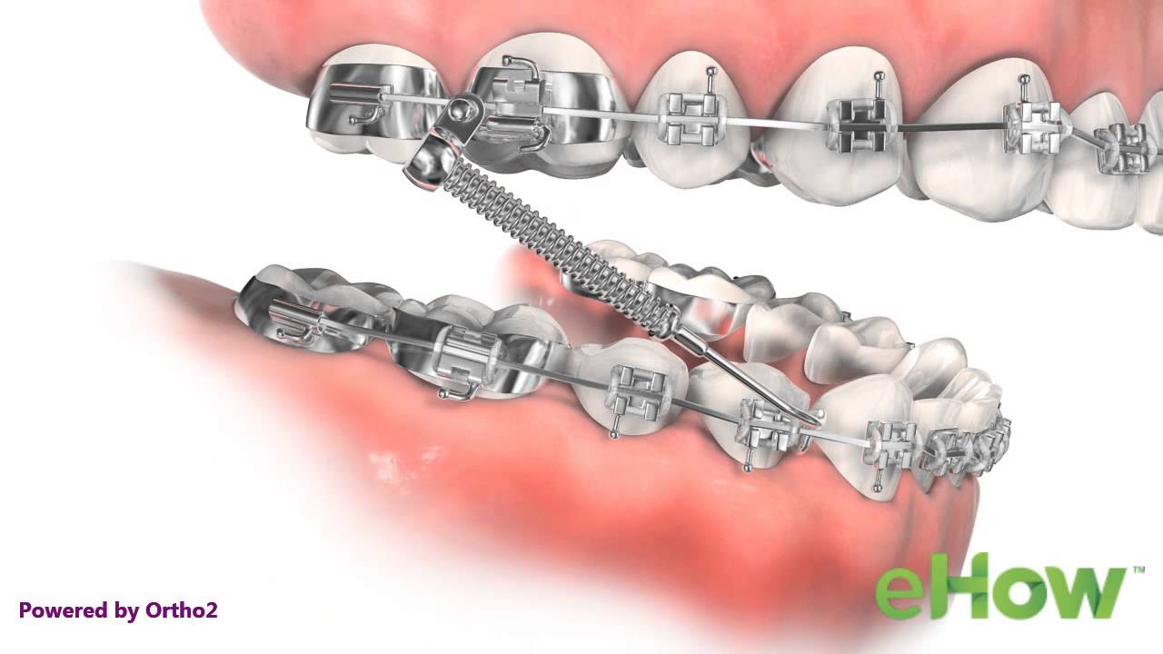 Forsus Appliance - YouTube