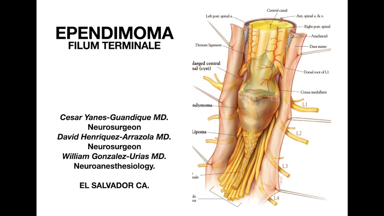 EPENDIMOMA OF THE FILUM TERMINALE... Microsurgical Resection ...