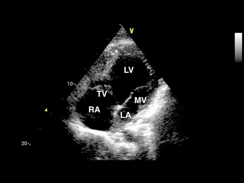 Double Inlet Left Ventricle Echocardiogram - YouTube