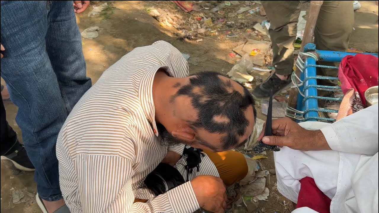 Alopecia Areata Treatment Process2024 | Patchy Hair Loss Areata ...