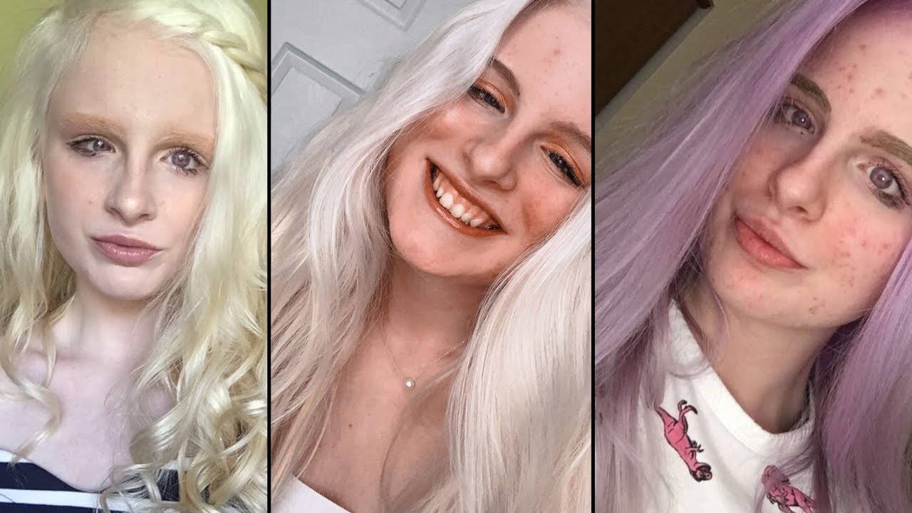 Albino People With Purple Eyes