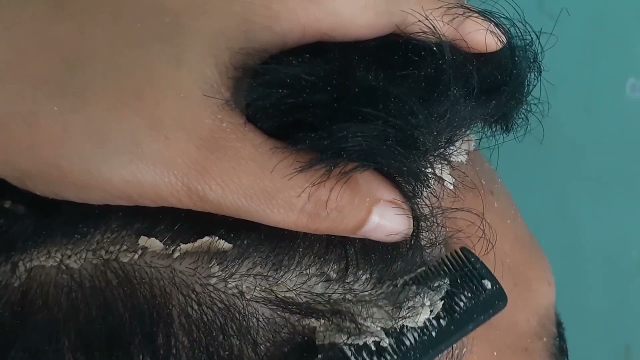 Big Flakes Dandruff Satisfying Flaky Scalp VDO #108. - YouTube