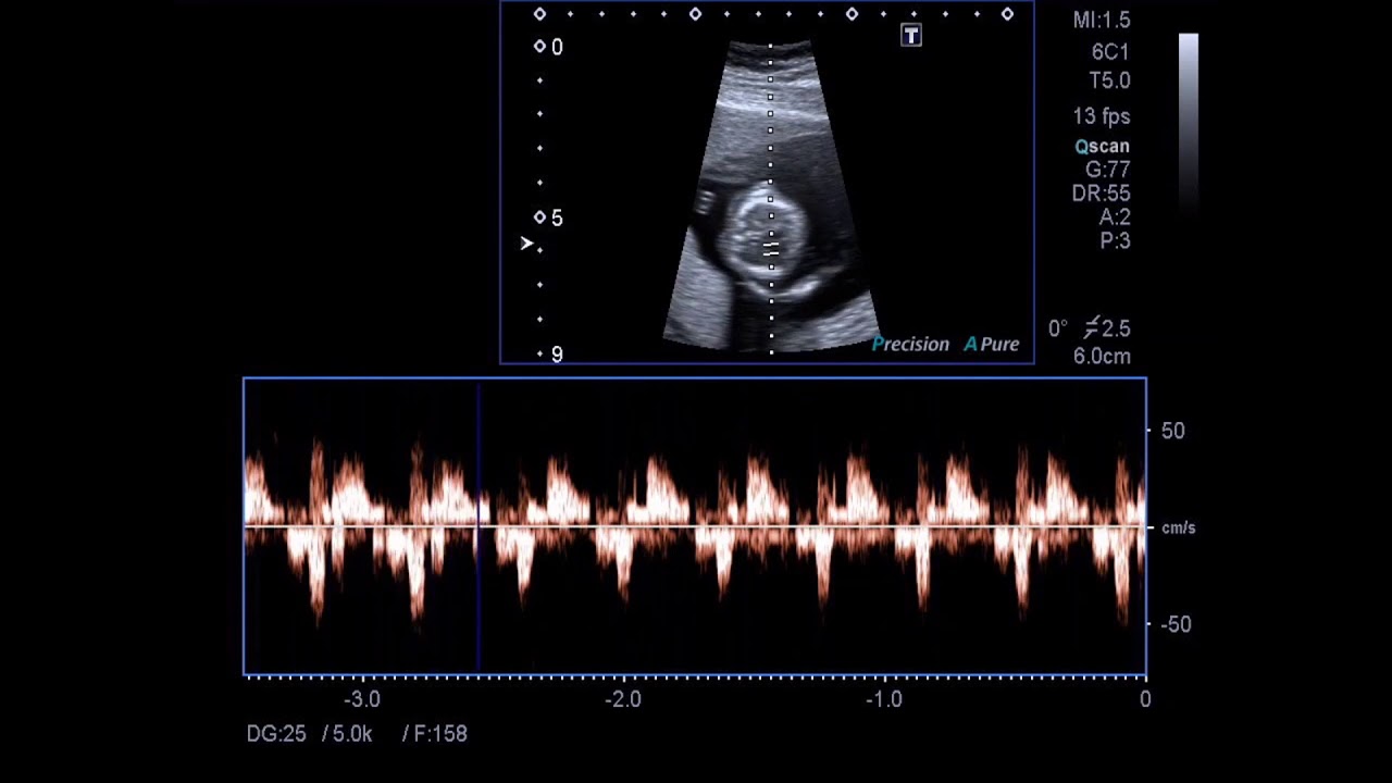 Fetal echo doppler - YouTube