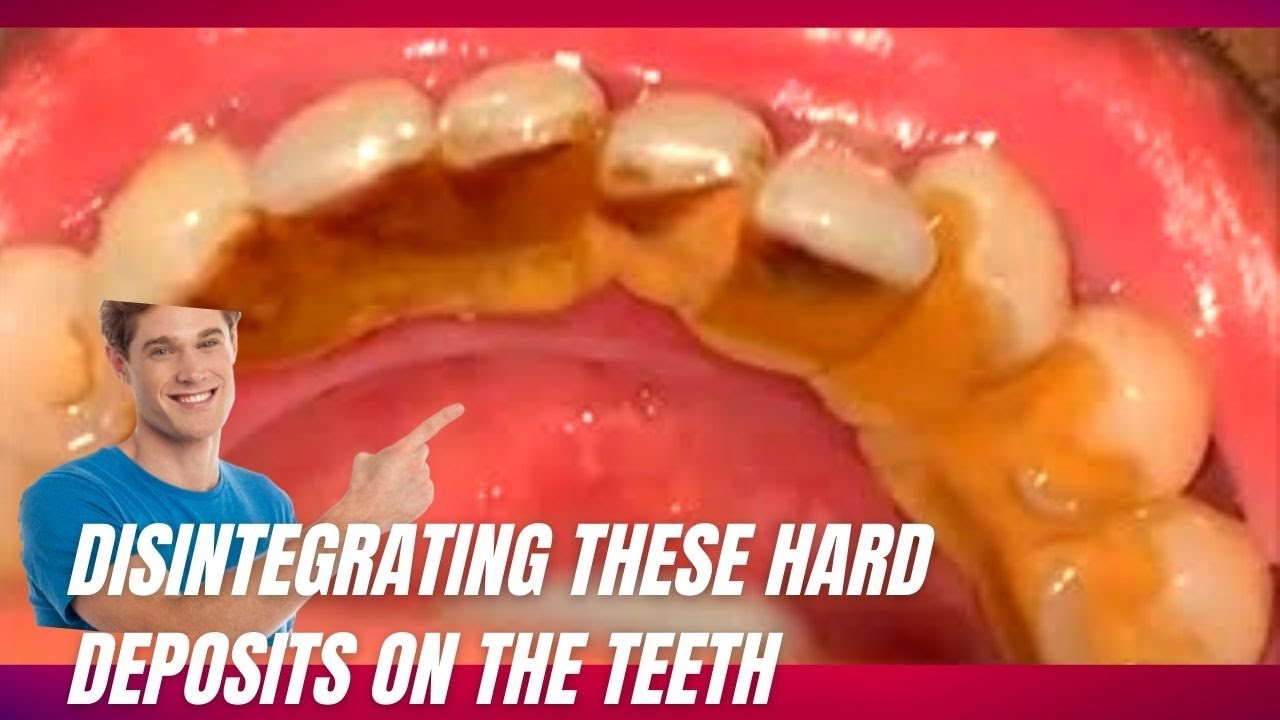 Disintegrating these hard deposits on the teeth. - YouTube