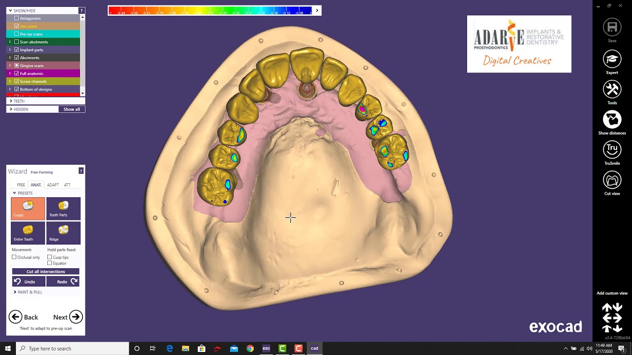 Hybrid Design with Exocad -Dr. Adarve - YouTube