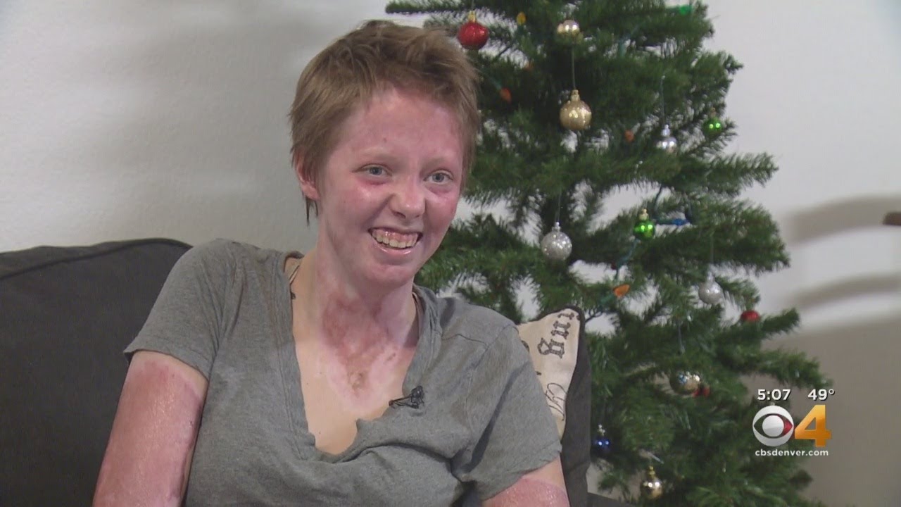 Abbey Alexander Handles Burn Scars With Humor - YouTube