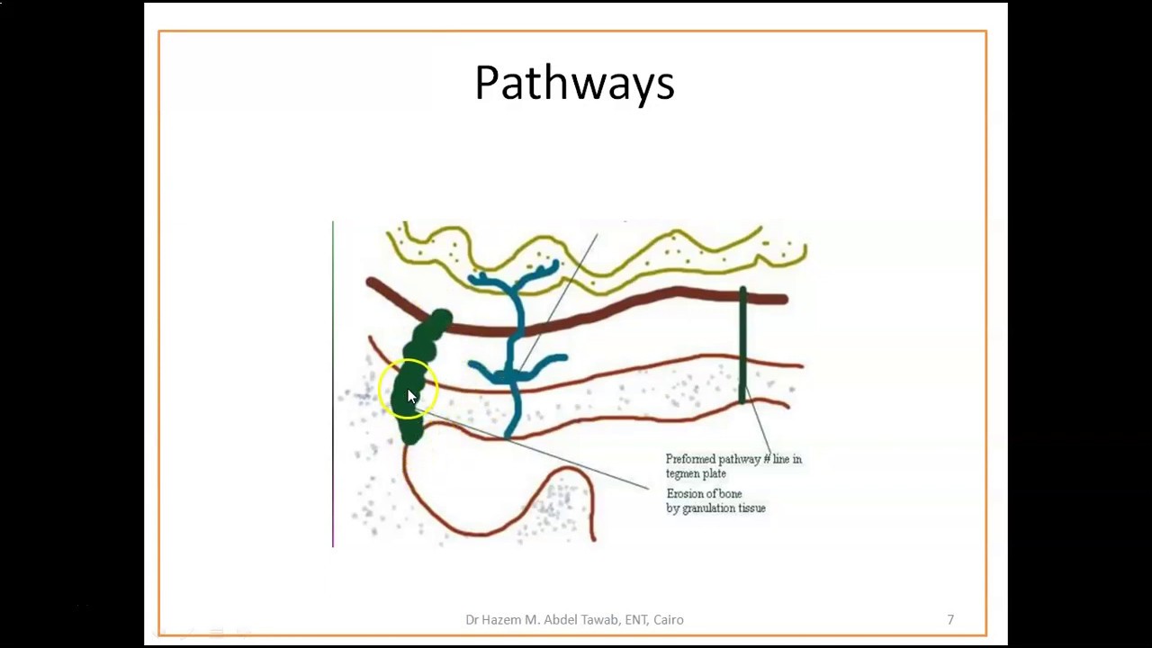 Complications of Otitis Media , 1 Mastoiditis - YouTube