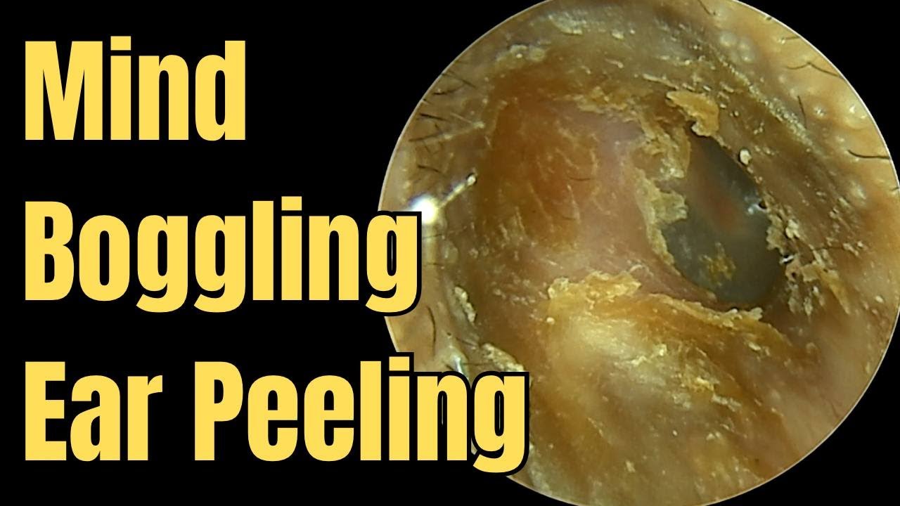 Mind Boggling Ear Peeling - YouTube
