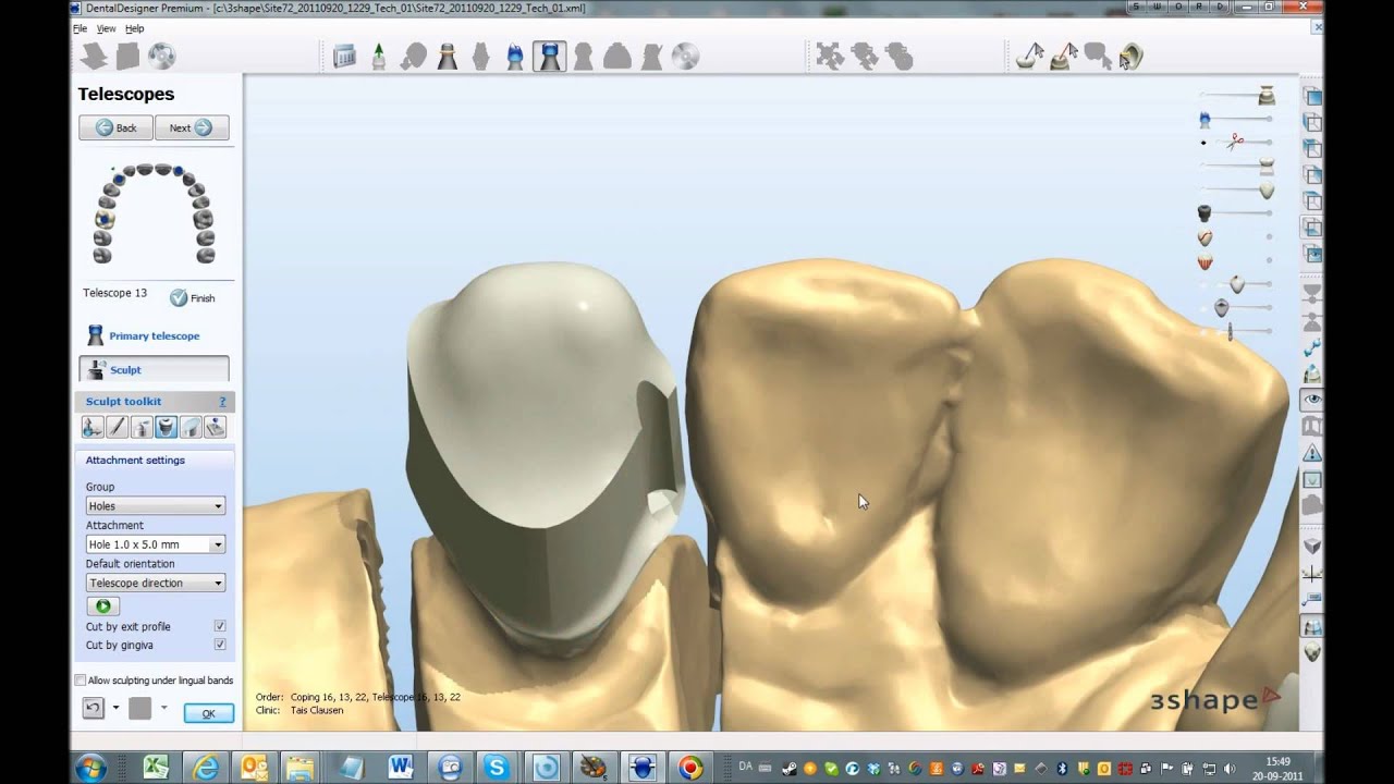 Advanced Telescope Design - Digital Dentistry Lebanon - Smile Center ...