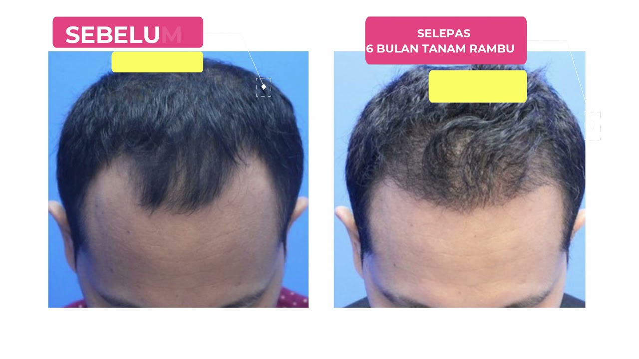 TESTIMONI 6 BULAN SELEPAS TANAM RAMBUT - YouTube
