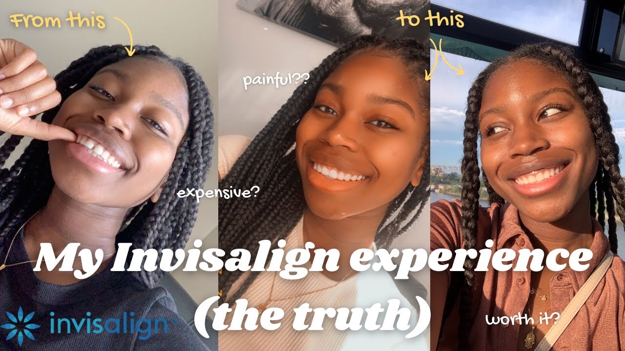 MY INVISALIGN EXPERIENCE, a review : the good, the bad, the ugly - YouTube