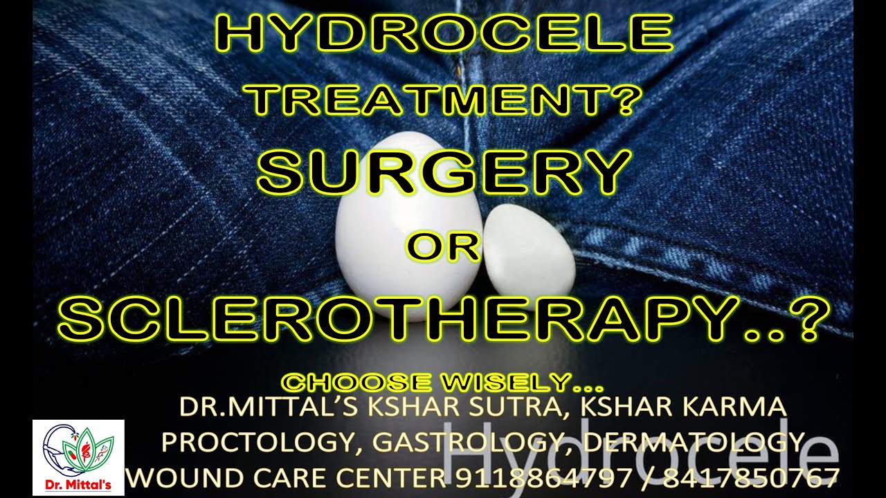 surgery or sclerotherapy for hydrocele, choose wisely - YouTube