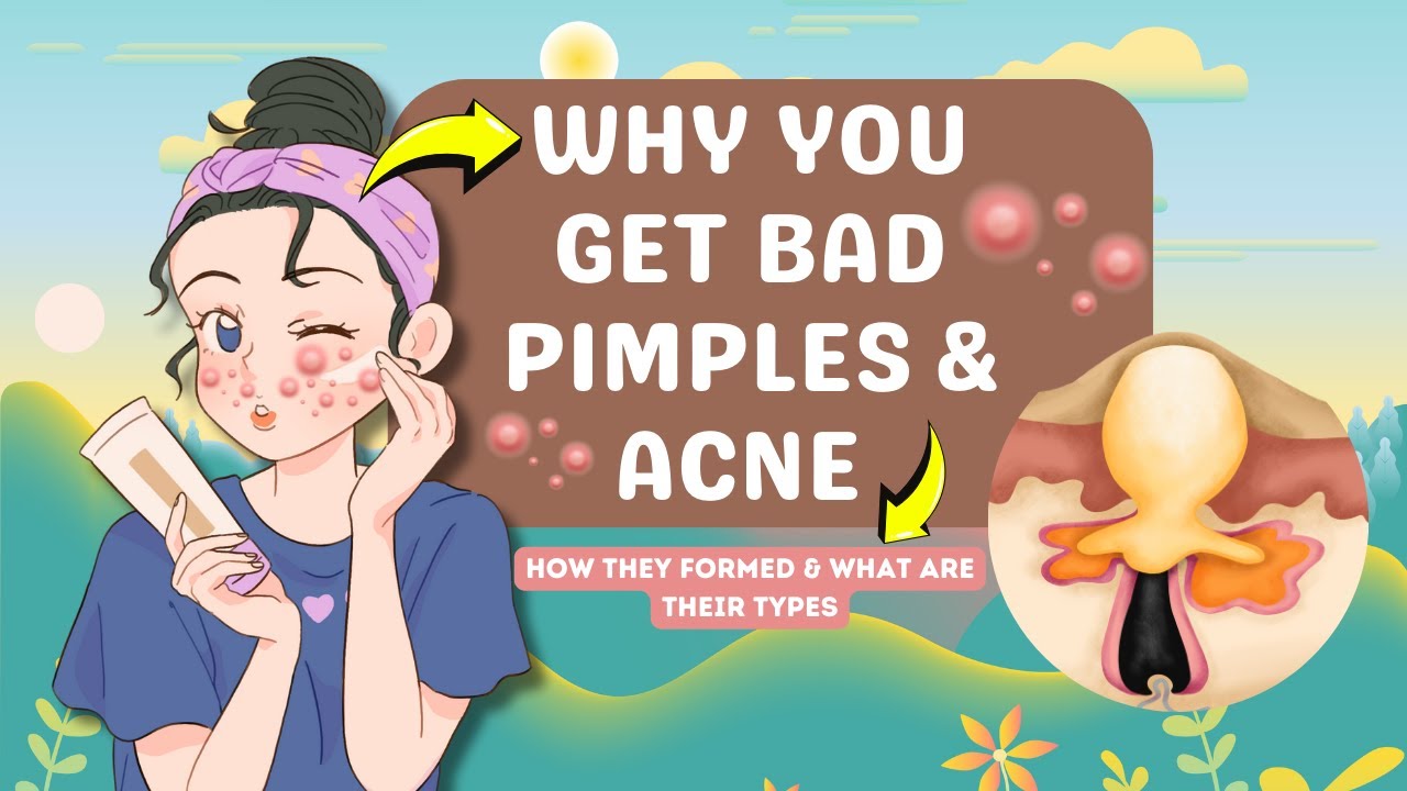 How Pimples and Acne Are Formed 🧐 and What are Their Types 😱👌 - YouTube
