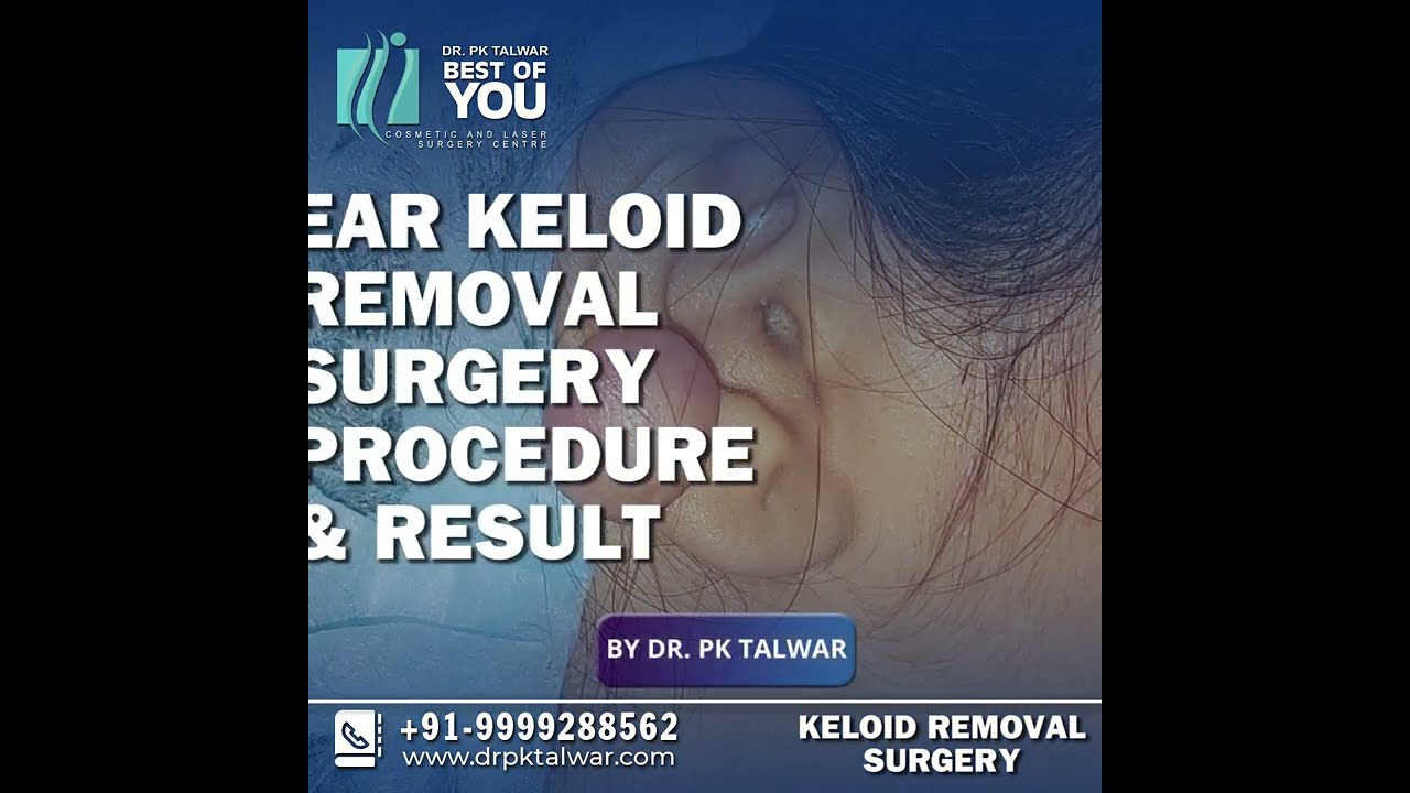 Ear Keloid Removal Surgery Procedure in Delhi, Before and After Results ...