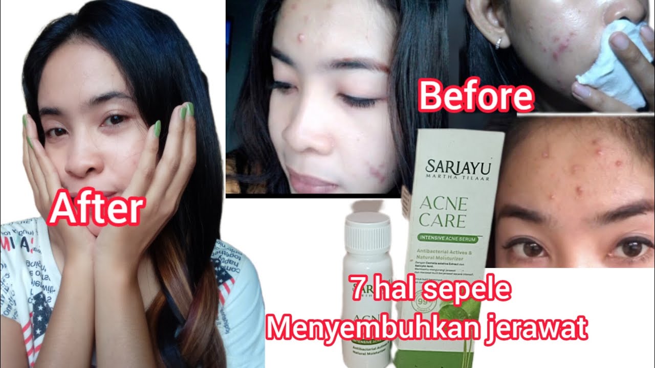 OBAT JERAWAT PALING AMPUH "AJAIB" ⁉️ACNE CARE, SEMBUHKAN BREAKOUT TOTAL ...