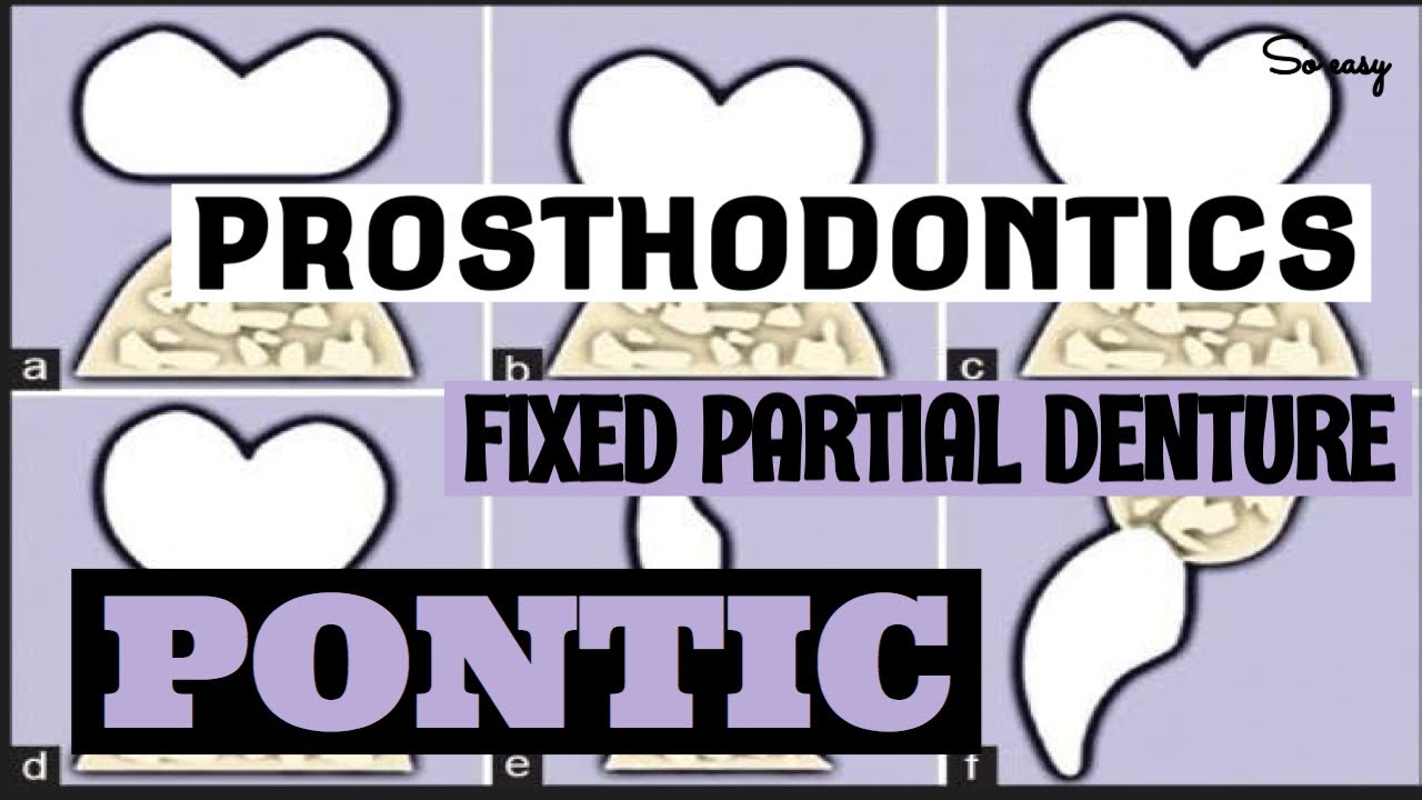 PONTIC II COMPONENT OF FIXED PARTIAL DENTURE II PROSTHODONTICS - YouTube
