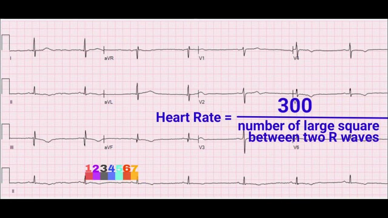 ECG|| Heart Rate calculation ||Cardiology - YouTube