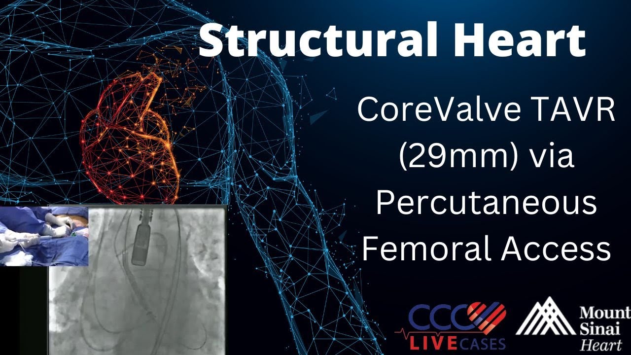 CoreValve TAVR (29mm) via Percutaneous Femoral Access Structural Heart ...
