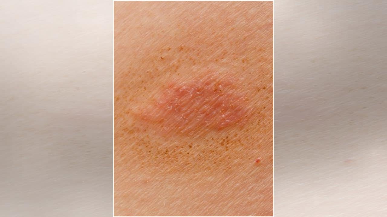 Grzybica skóry - YouTube