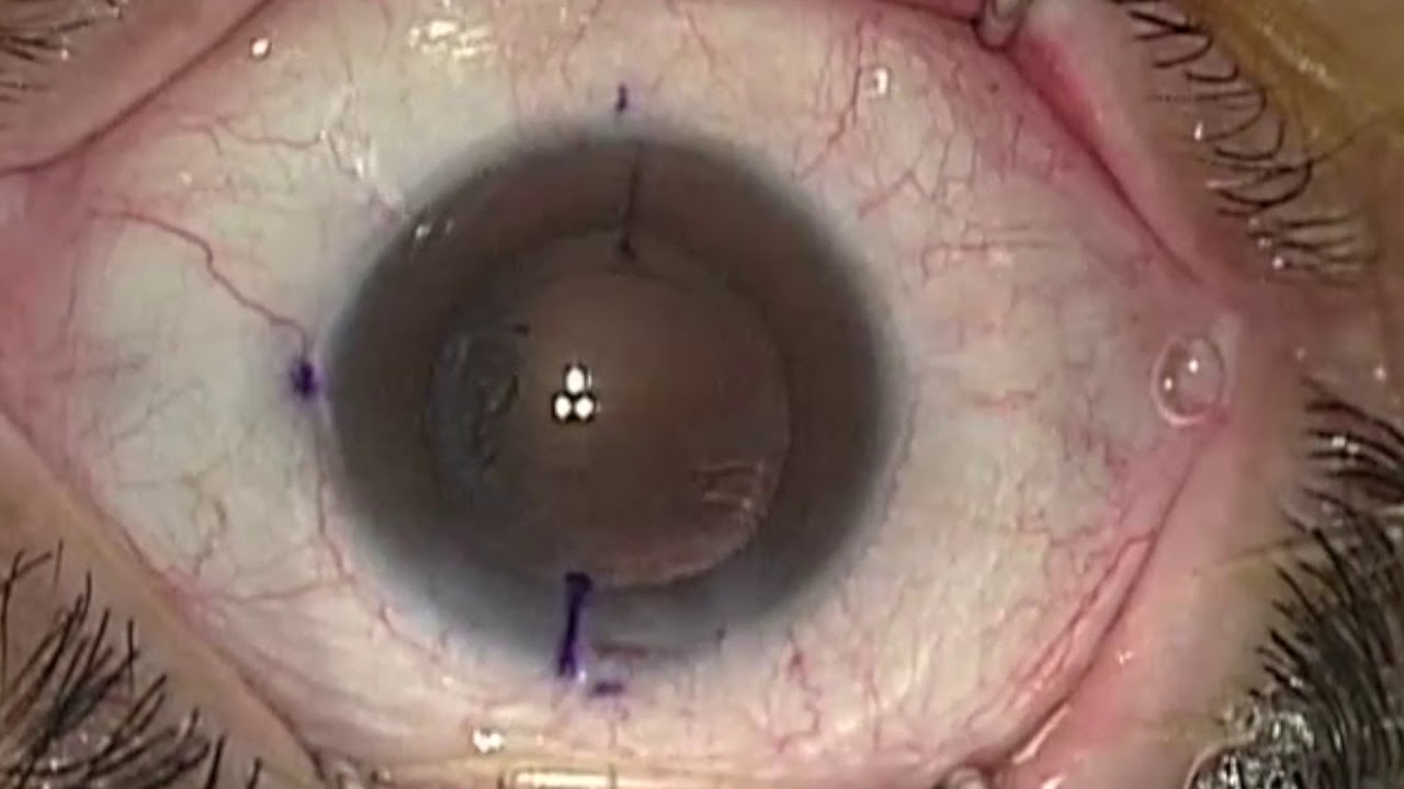 Toric IOL with manual marker by Dr Amer Awan - YouTube
