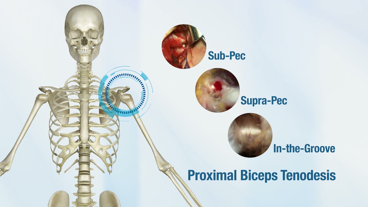 MEDHOLD tenolok tenodesis anchor product video - YouTube