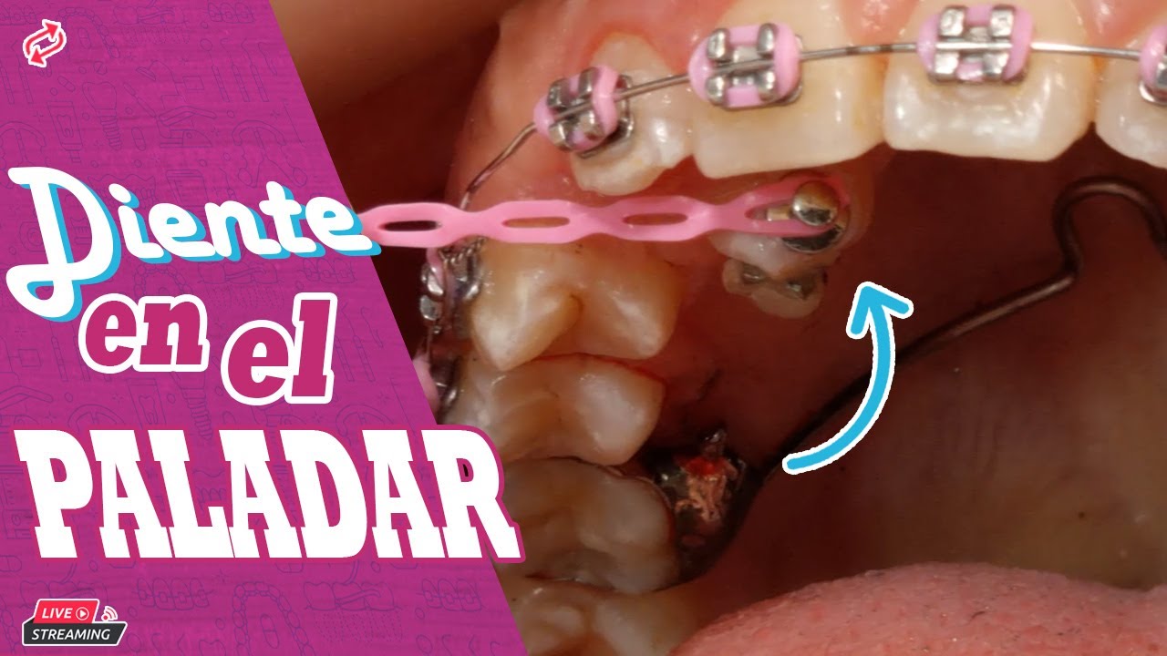 🔴 POV: Diente en PALADAR 😰|/COMO mover un diente con brackets? - YouTube
