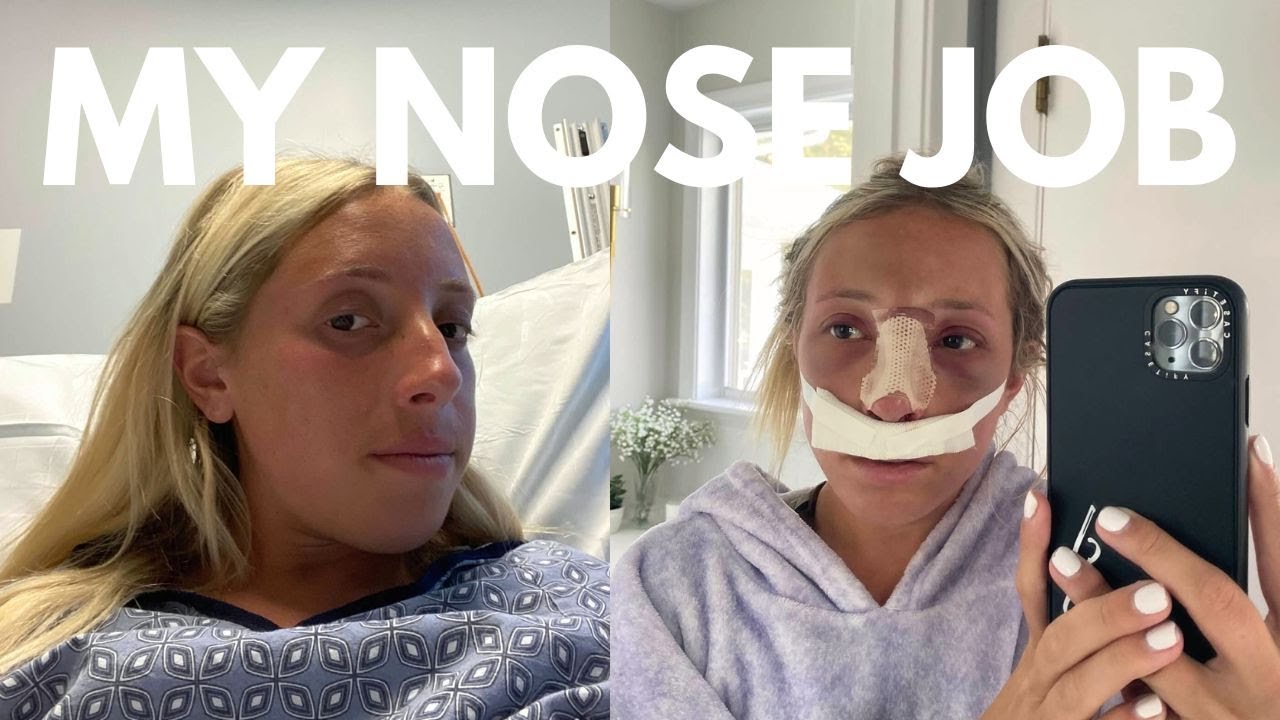 I got a NOSE JOB | daily recovery, what you need to know - YouTube