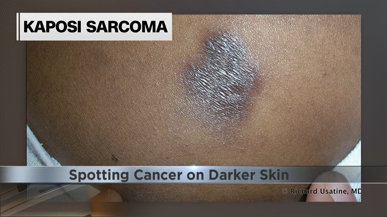 How to spot melanoma and other cancers on darker skin - YouTube