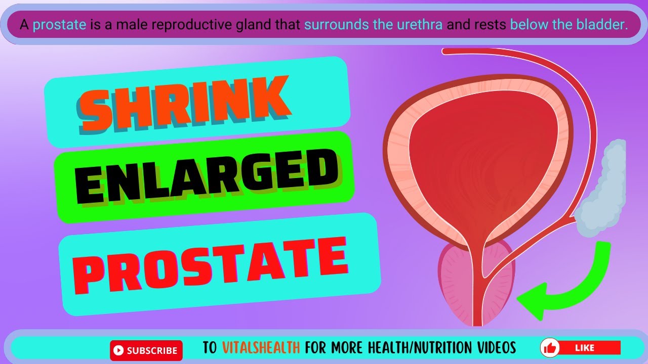 ENLARGED PROSTATE (BPH)-Causes and health implication - YouTube