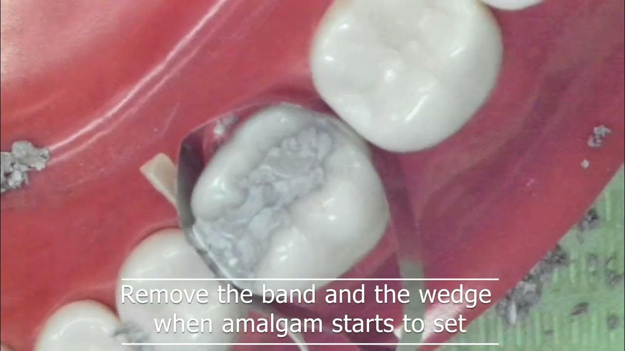 Class II amalgam restoration - YouTube