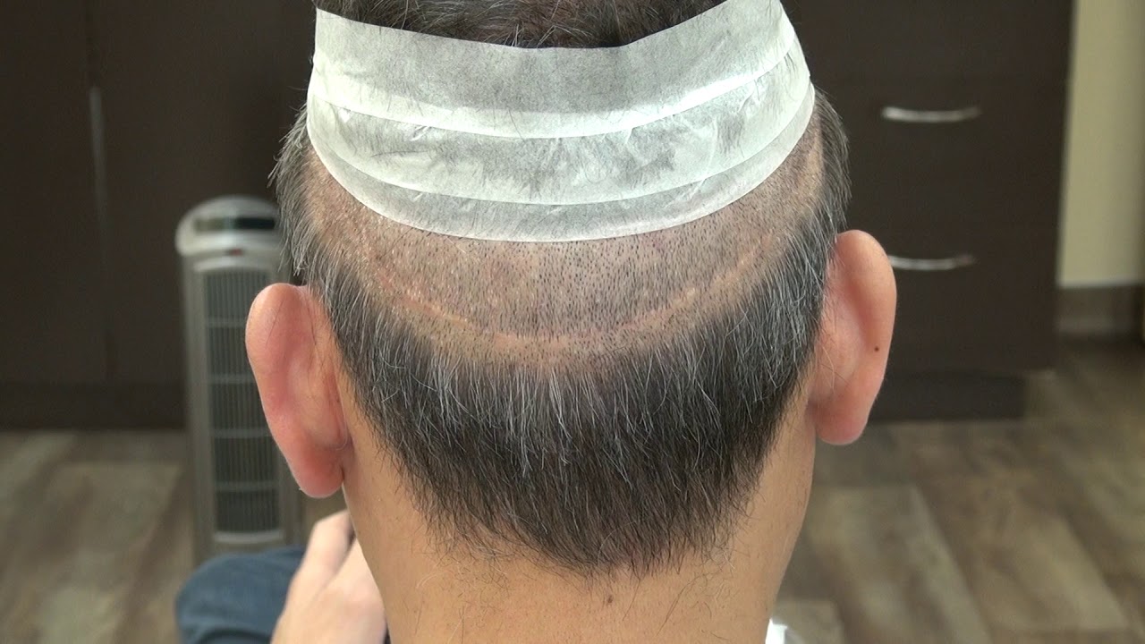 What is a FUT Donor Scar? by Dr. Diep - YouTube