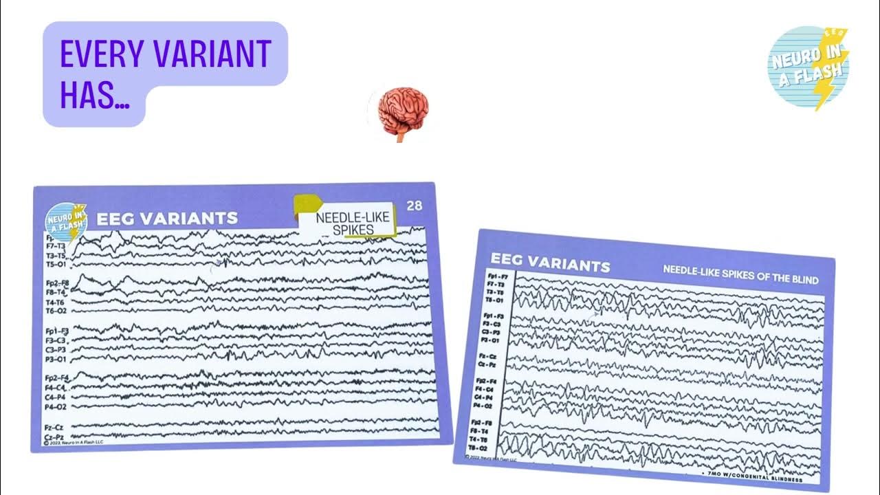 EEG Variants, RMTD, Wickets, LAMBDA, SREDA, MU Rhythm, flashcards for ...