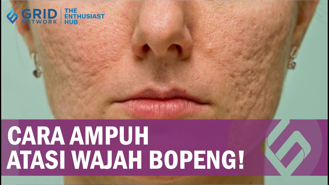 Perawatan ampuh untuk atasi wajah Bopeng - YouTube