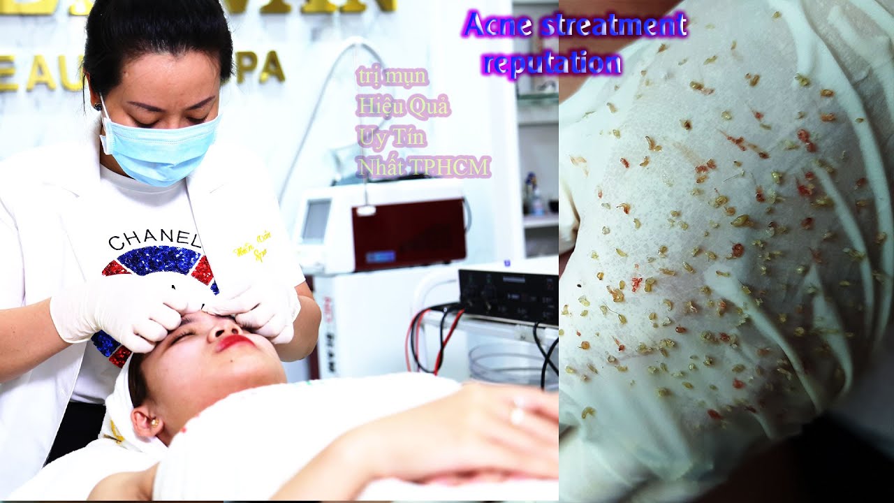 Acne Treatment,Huge Cystic,Blackhead Extraction at Hien Van Spa-385-Đại ...