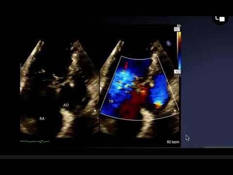 Aorta- Right atrial fistula echocardiography @SafaMedicalLecture - YouTube