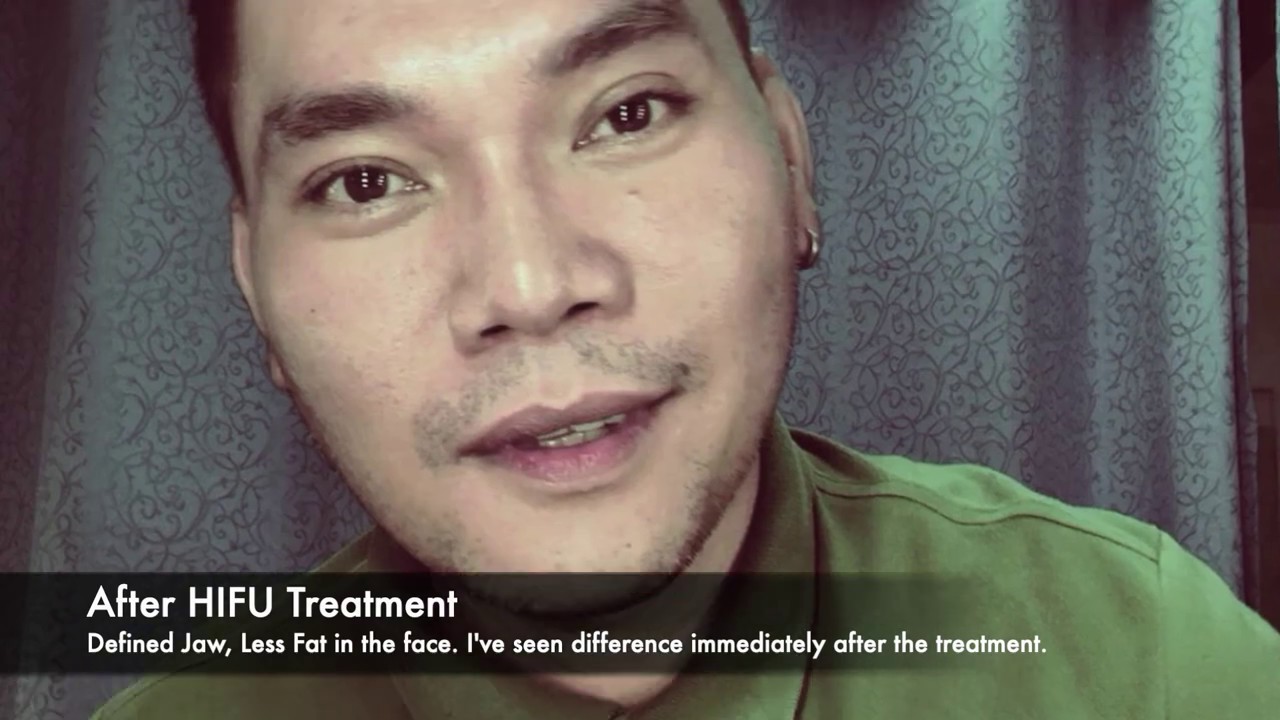 My HIFU experience at The Aesthetics Studio by Kristine Lucas | Hugis ...