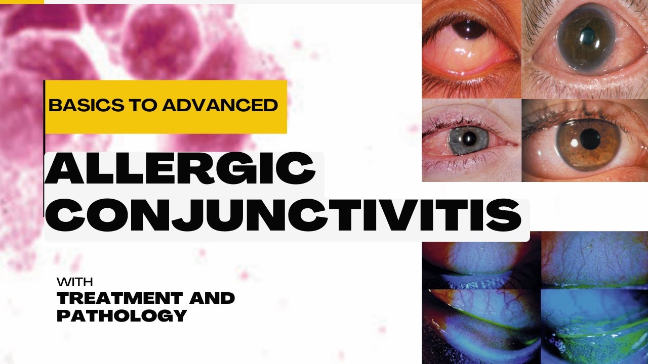 Allergic Conjunctivitis: Classification, Pathophysiology, Treatment ...