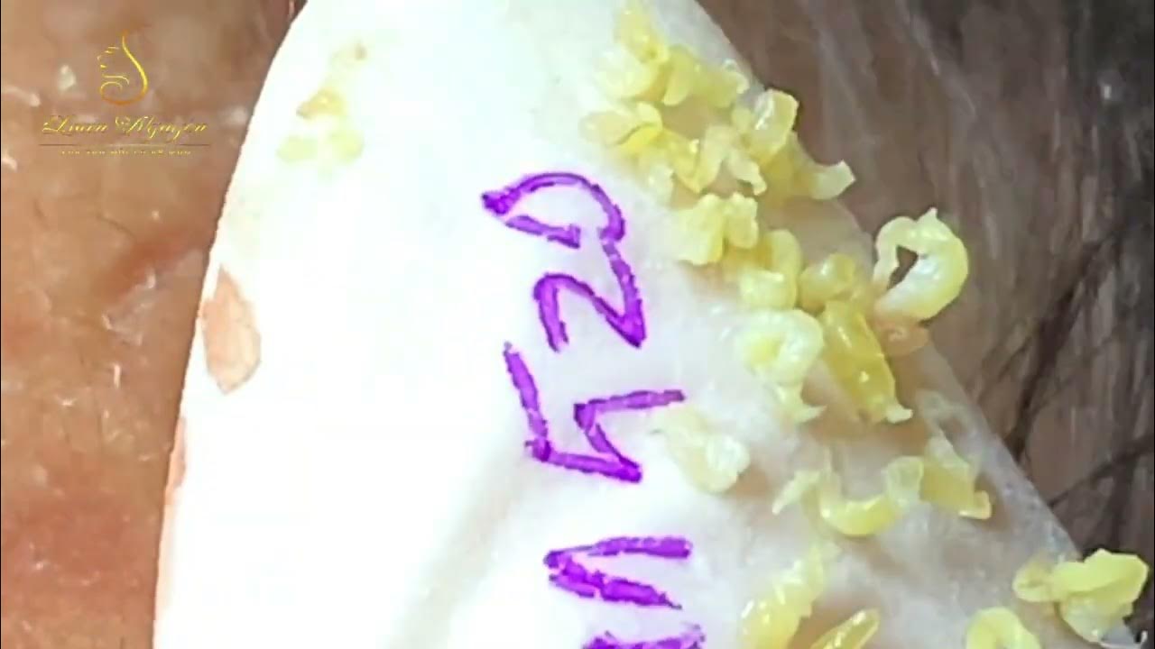 Blackhead Extraction The Most Satisfying Video Ever Youtube