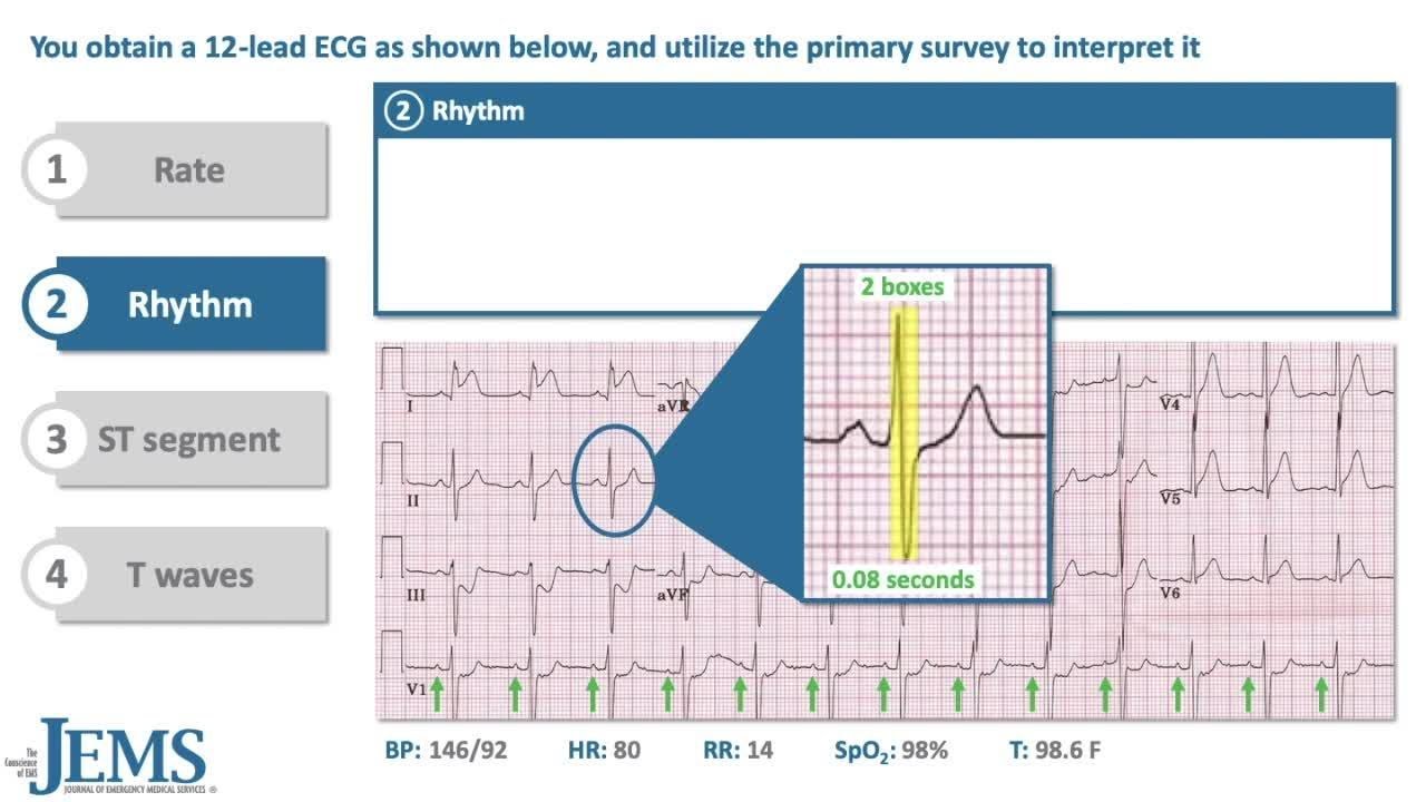ECG Consult: 55yo Firefighter with Acute Chest Pain #6063167379001 ...