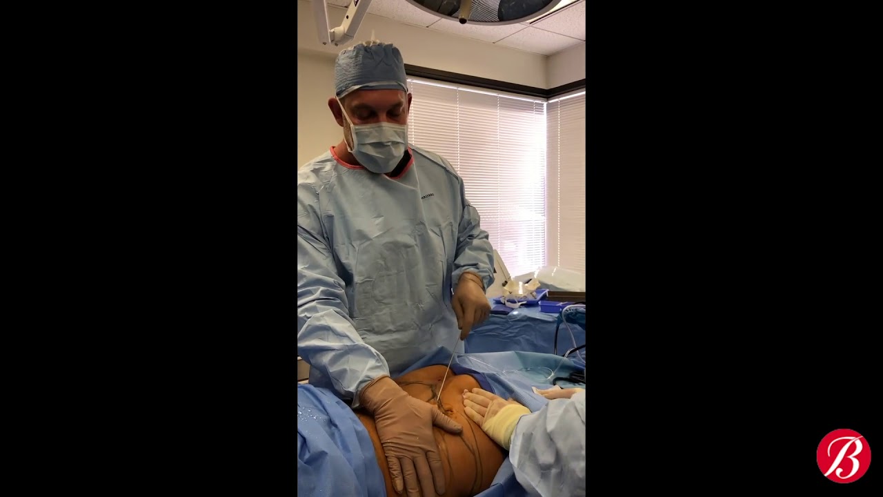 Liposuction [Behind the Scenes] - YouTube