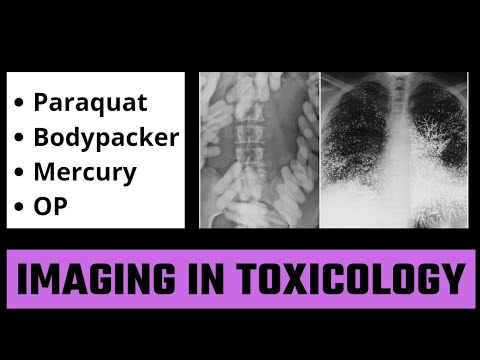 Imaging in Toxicology || Body packer || Mercury || OP || Iron ...