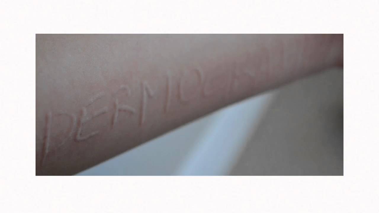 Dermographism - YouTube