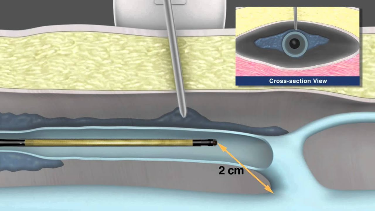 NVVVC uses the VNUS Closure Procedure - YouTube