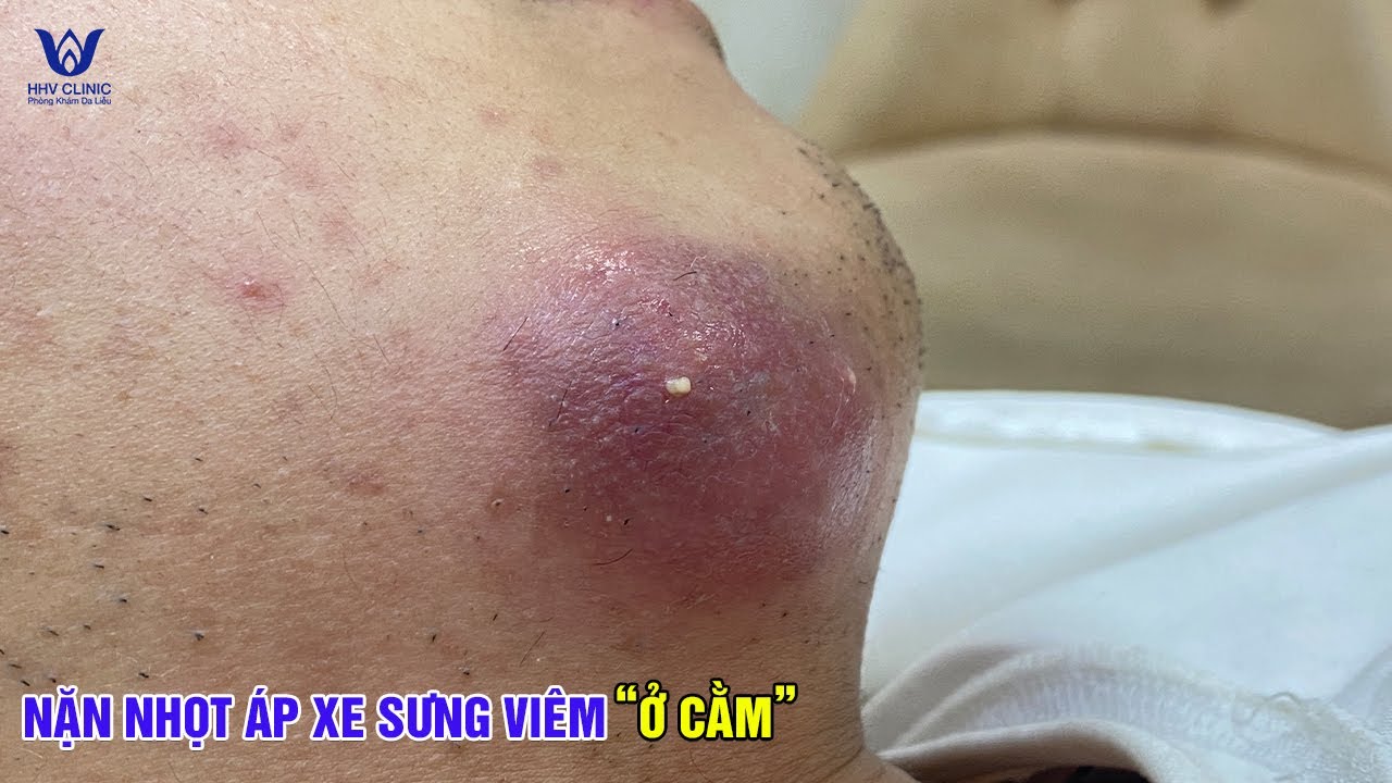 Nặn mụn nhọt áp xe sưng viêm nhiều dịch mủ ở cằm. - YouTube