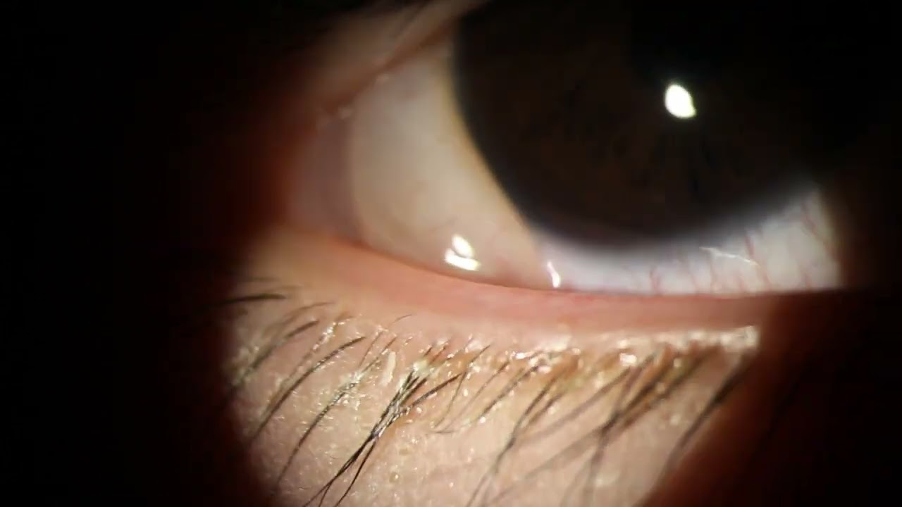 Chemosis - allergy blister on the white of the eye! - YouTube