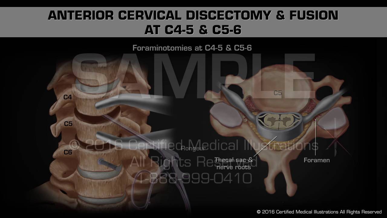 Anterior Cervical Discectomy & Fusion at C4-5 & C5-6 - YouTube