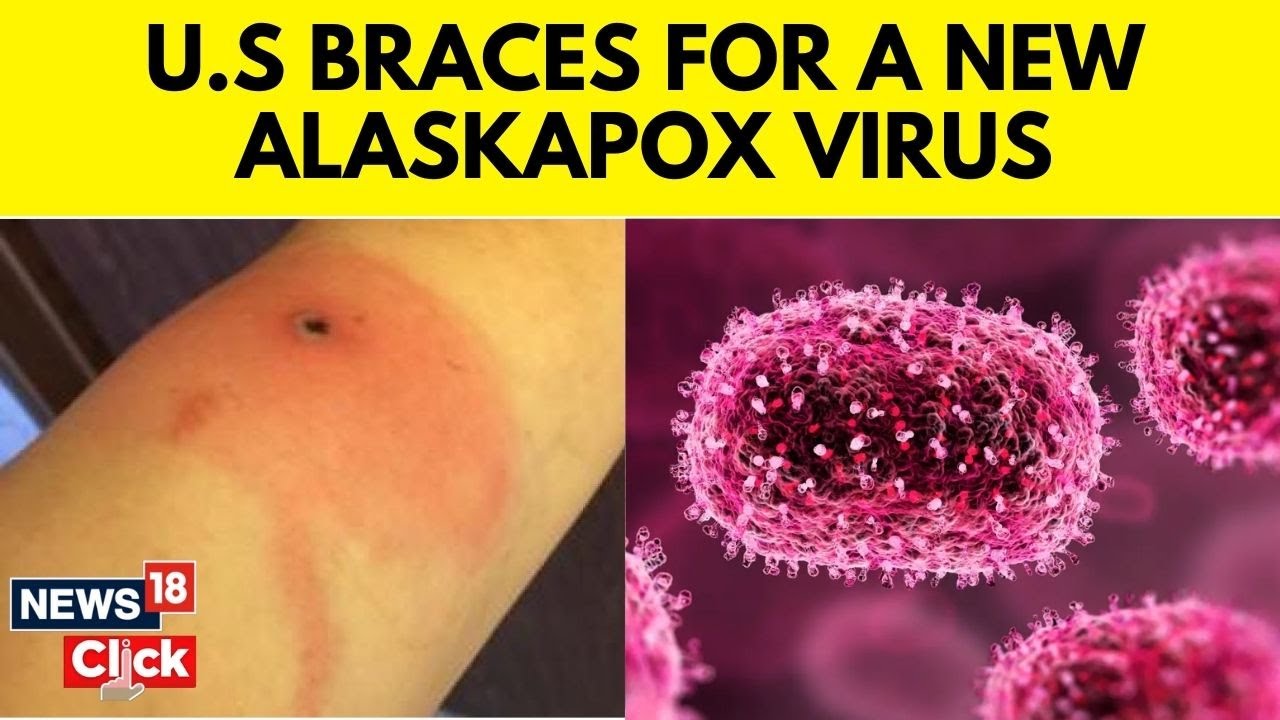 Alaskapox | New Virus Sparks Scare In US | Explained: What Is Alaskapox ...