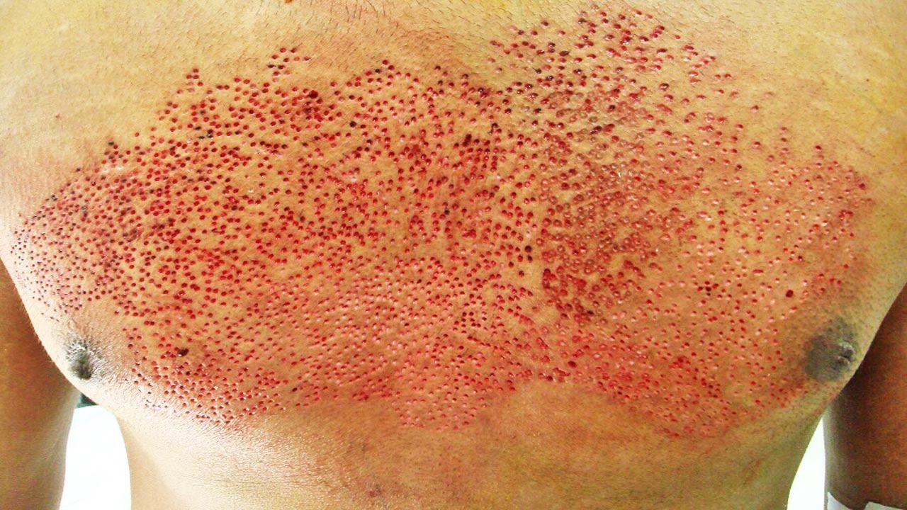 Hair Transplants and Trypophobia! (Cysts, Boils, Whiteheads and ...